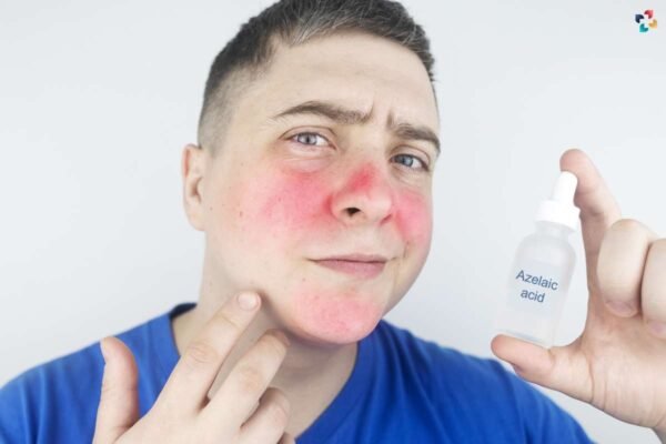 2 Important Skin Benefits Of Azelaic Acid | The Lifesciences Magazine