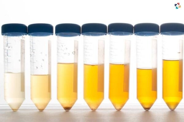 What Does The Color Of Urine Mean? 7 Spectrum Of Urine Color | The ...