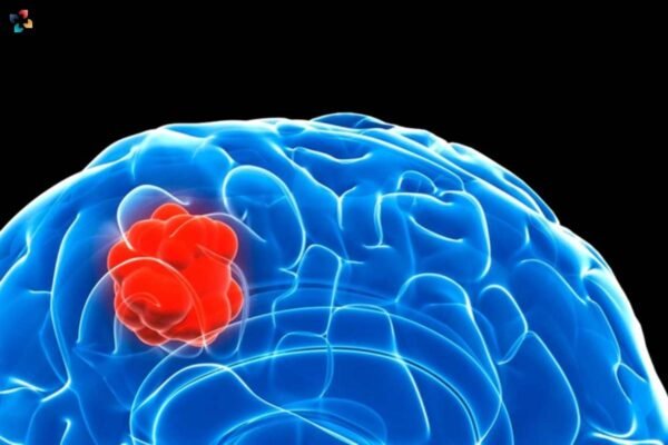 Glioblastoma Multiforme: Diagnosis, Treatment Therapeutic Approaches ...
