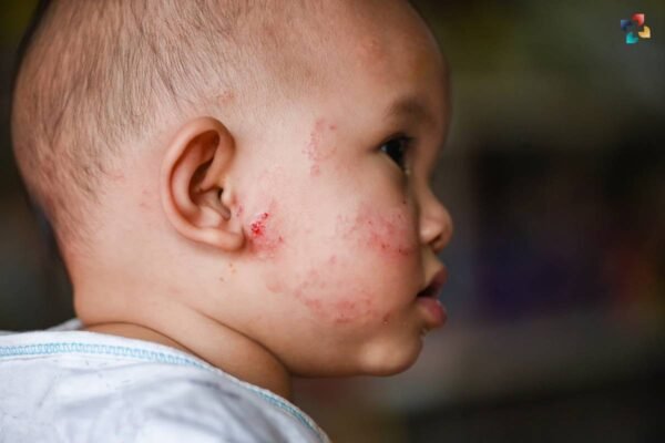 Eczema On The Face: 5 Common Causes, Symptoms, And Relief Options ...