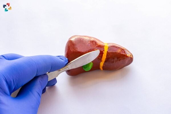 Gallbladder Removal: Indications, Procedure, And Recovery | The ...
