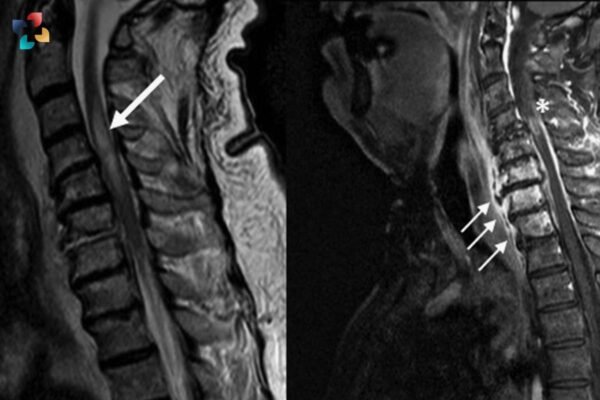 Transverse Myelitis: Symptoms, Causes, Diagnosis, And Treatment Options ...