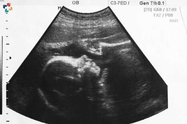 Biophysical Profile (BPP): Components, Significance, Interpretation ...