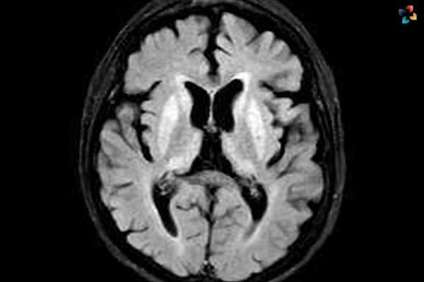 Creutzfeldt-Jakob Disease: Causes, Symptoms, And Treatment | The ...