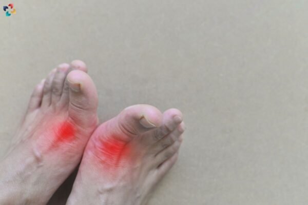 Uric Acid: Pathophysiology Of Hyperuricemia And Gout | The Lifesciences ...
