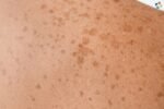 Nonmelanoma Skin Cancer: Types, Causes, Symptoms And Treatment | The ...