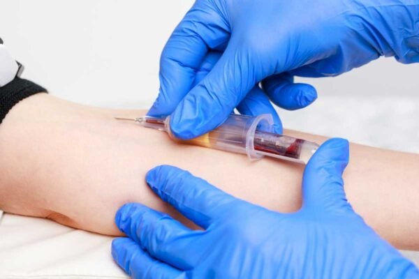 Blood Urea Nitrogen Test: Understanding Its Importance | The ...