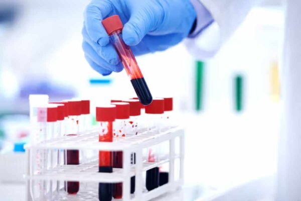 Electrophoresis Protein Tests: Types, Functions And Results | The ...