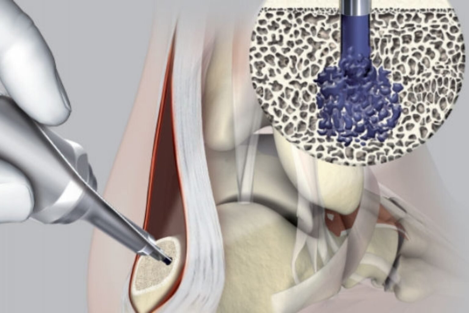 Orthopedic Implants: Types, Materials & Innovations | The Lifesciences ...