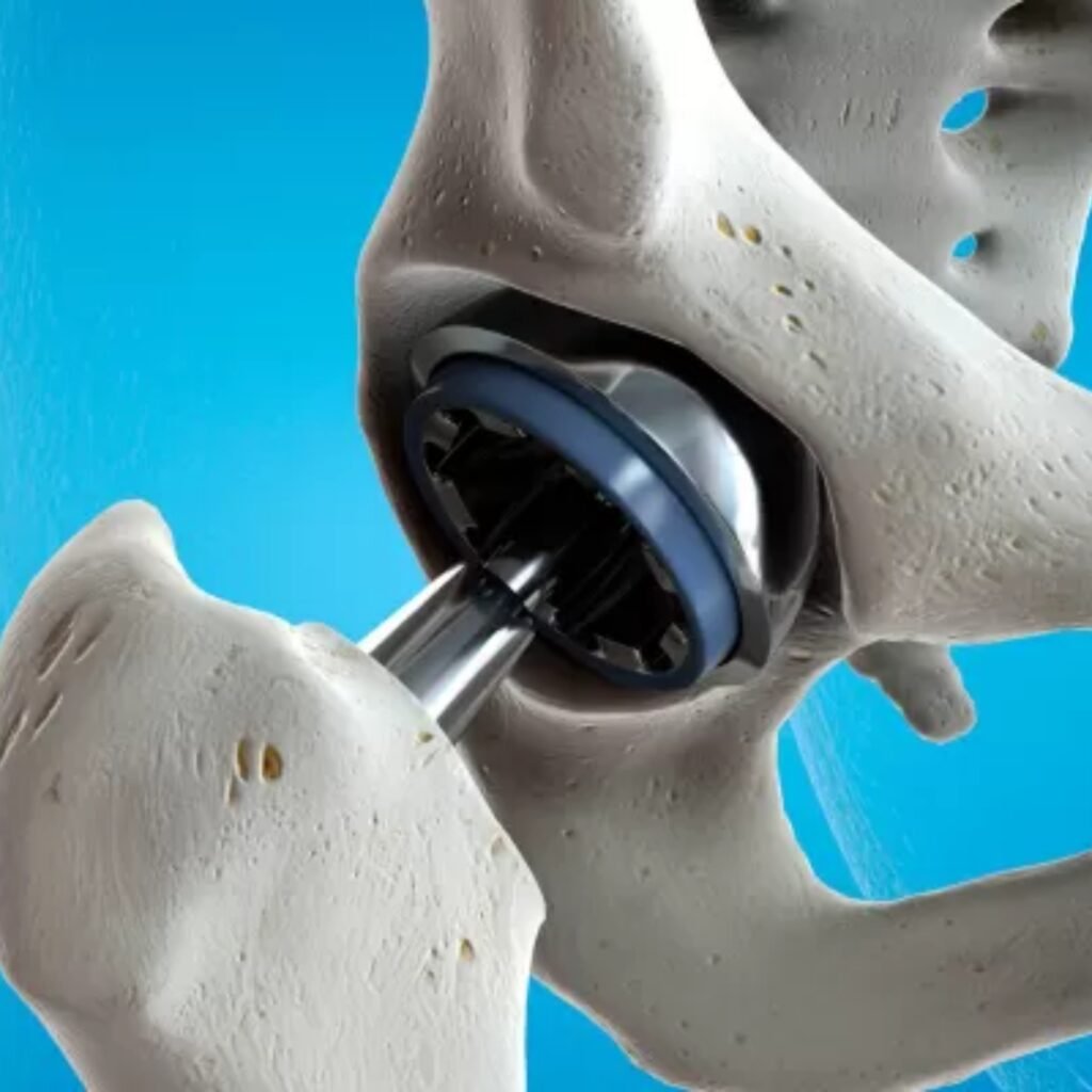 Orthopedic Implants: Types, Materials & Innovations | The Lifesciences ...