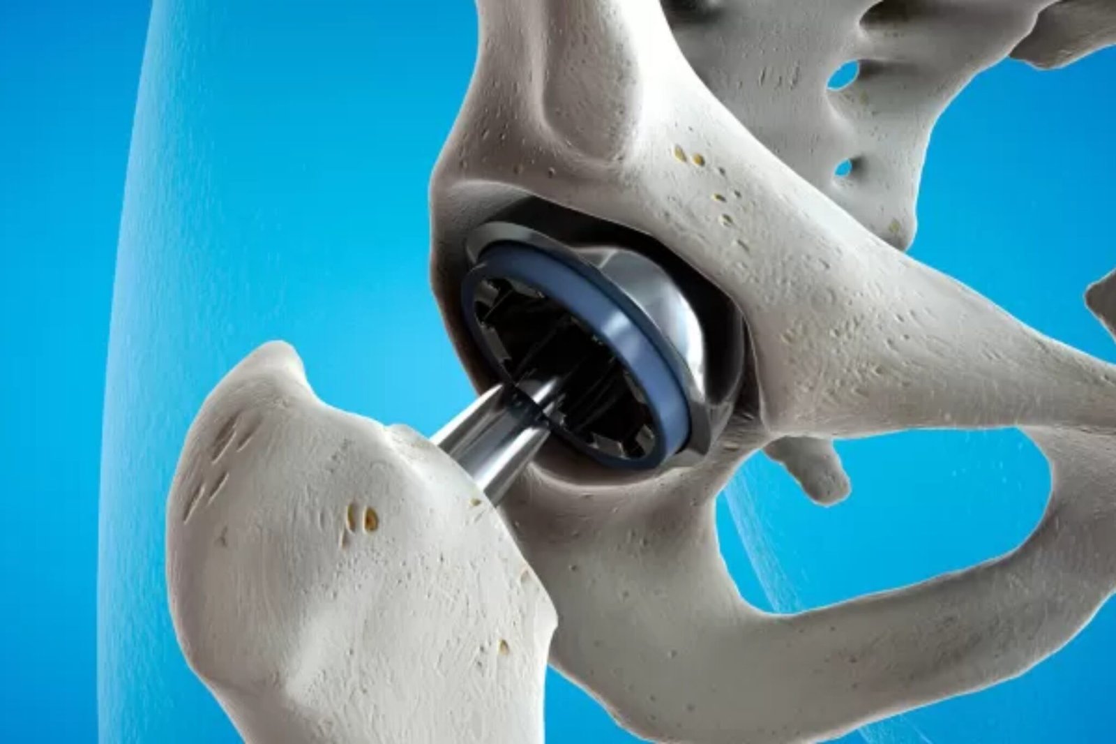 Orthopedic Implants: Types, Materials & Innovations | The Lifesciences ...
