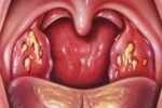 White Spots On Tonsils: Causes & When To See A Doctor | The ...