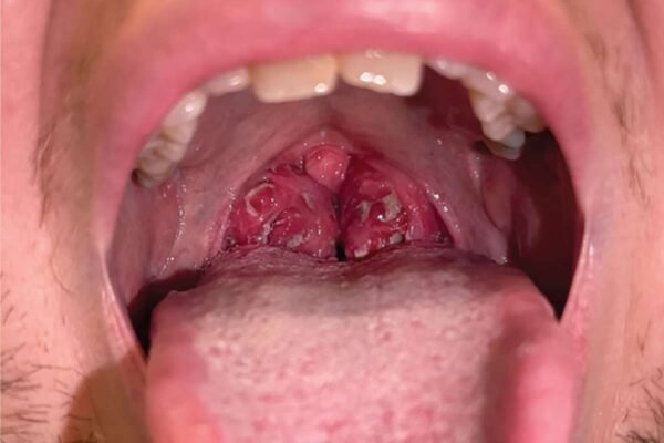 White Spots On Tonsils: Causes & When To See A Doctor | The ...