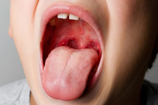 Why White Spots On The Throat May Signal Something Serious | The ...